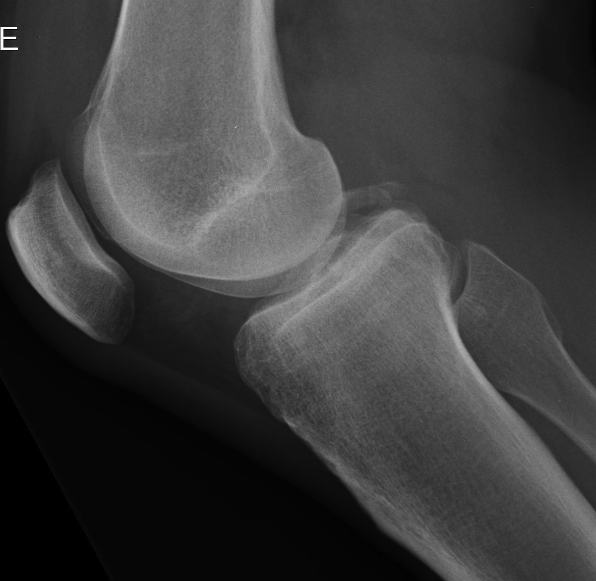 Open Approach for Bony Avulsion Surgical Technique | The Bone School