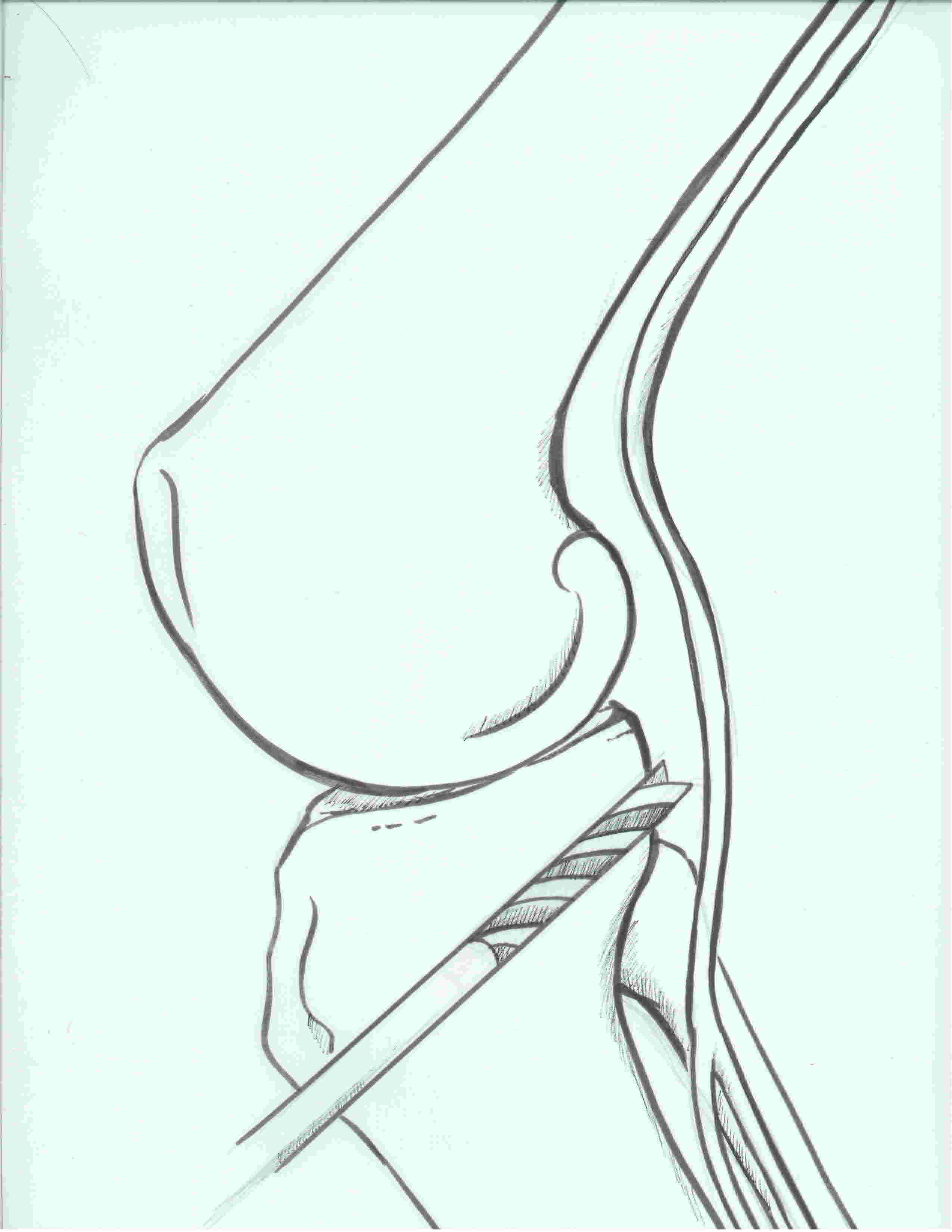 Arthroscopic Reconstruction PCL Technique Single Bundle | The Bone School