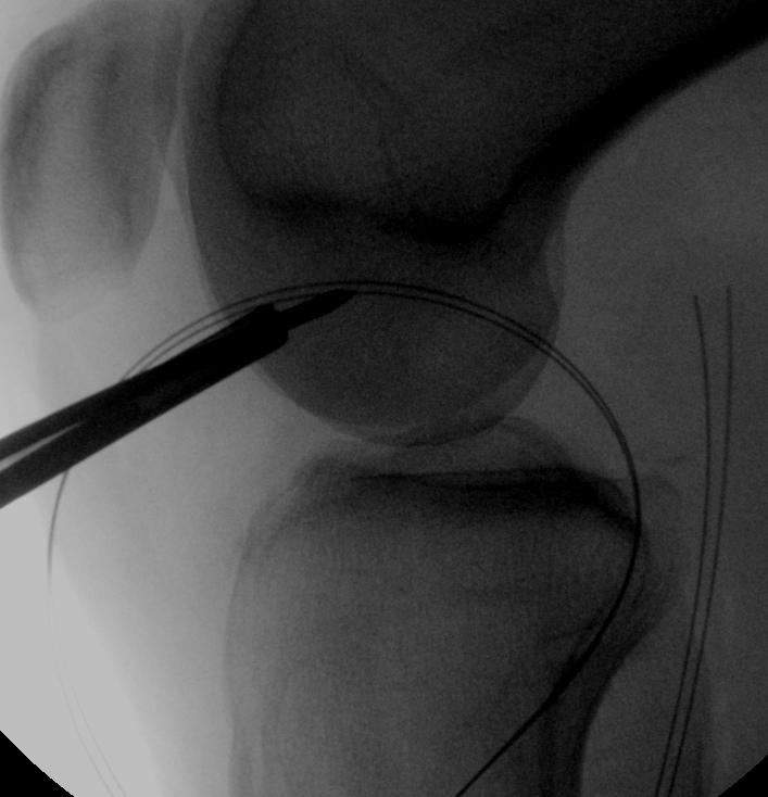 LARS PCL Reconstruction Technique | The Bone School