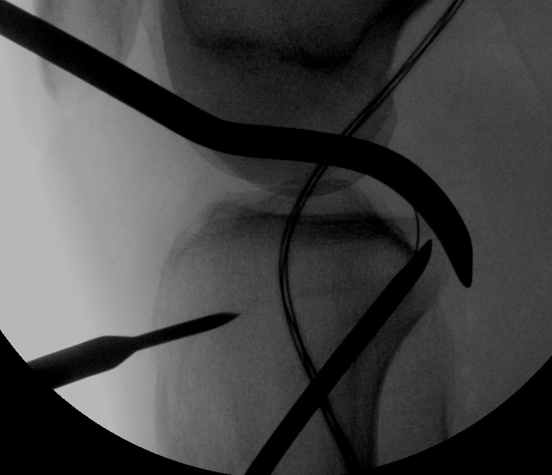 LARS PCL Reconstruction Technique | The Bone School