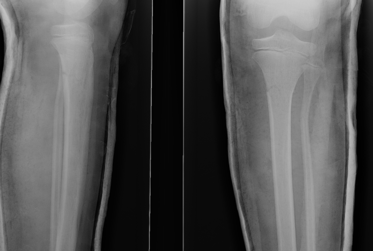 Tibial Fractures | The Bone School