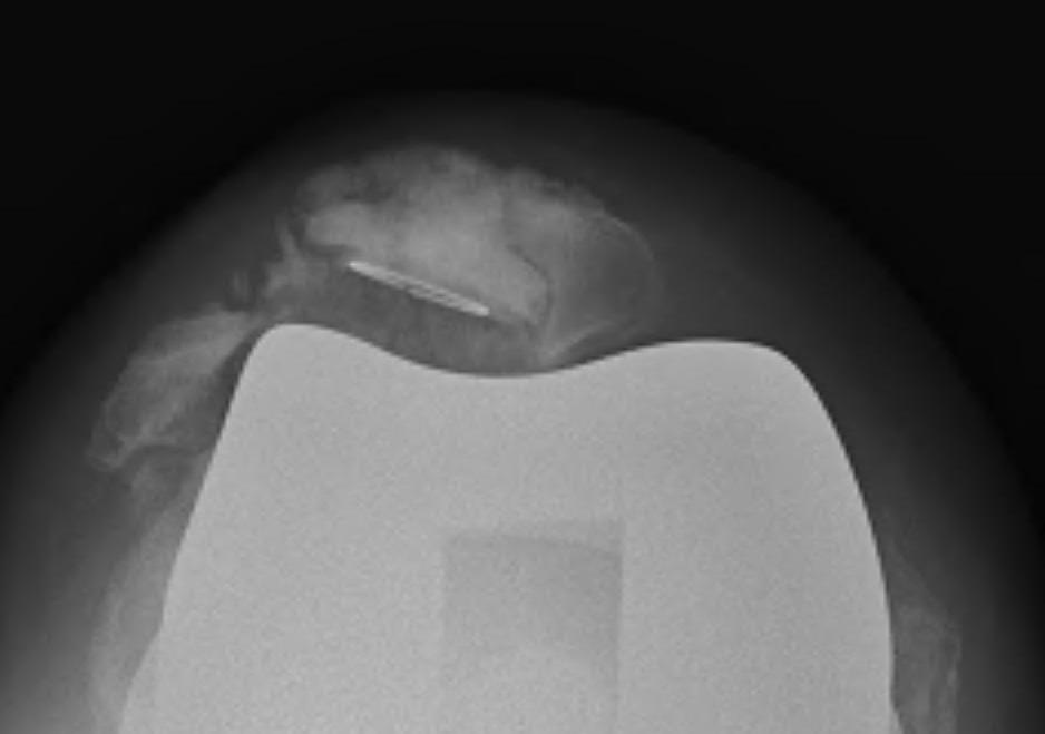 Patella | The Bone School