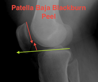 Patella Baja