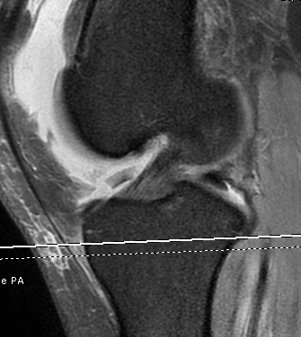 Acute Patella Dislocation | The Bone School