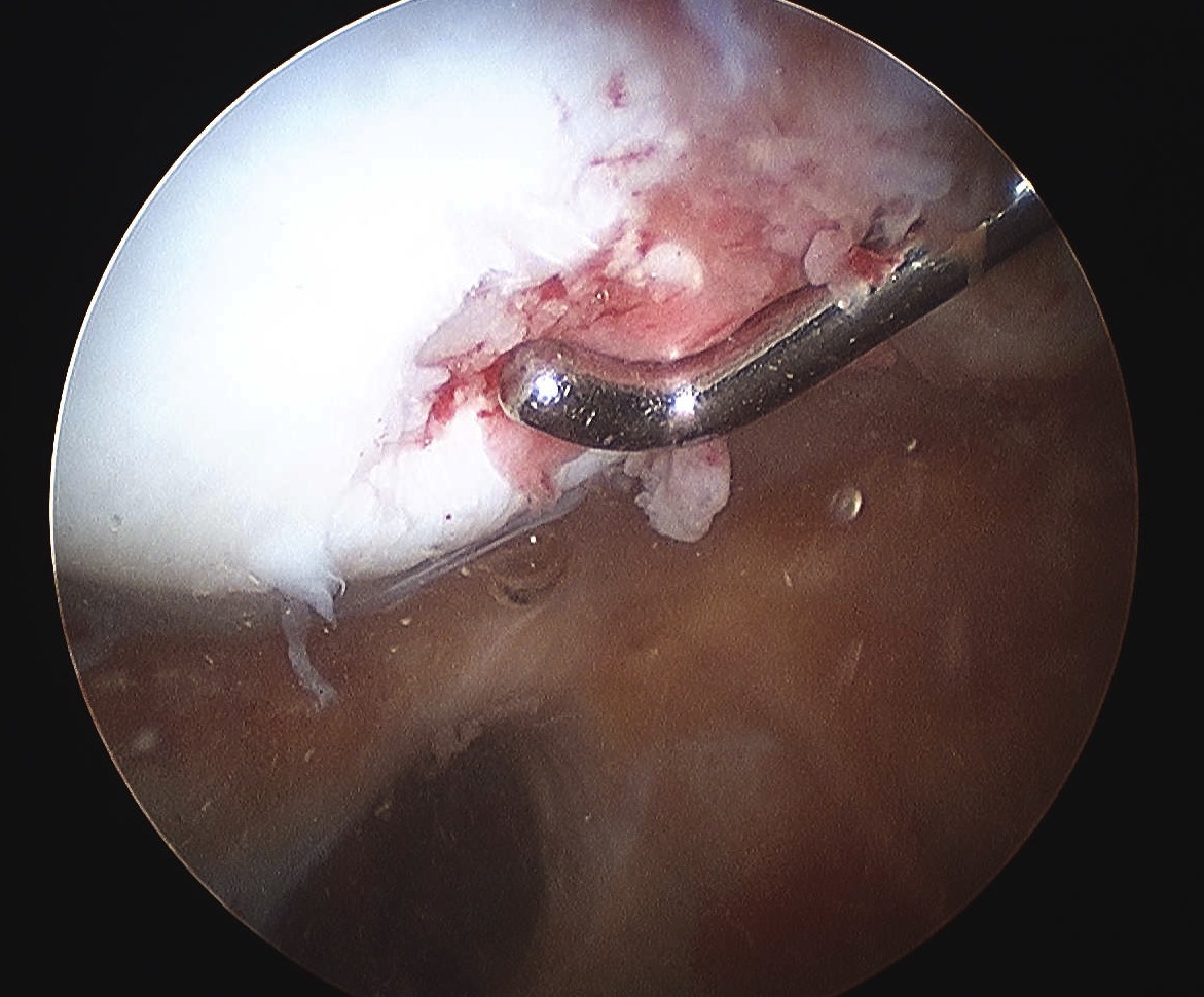 Acute Patella Dislocation | The Bone School