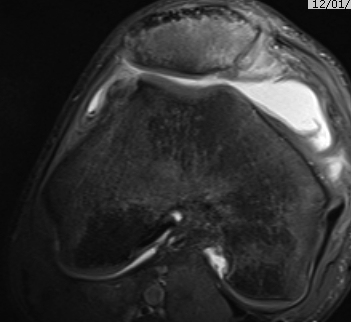 Acute Patella Dislocation | The Bone School