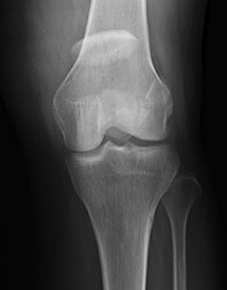 Patella Fracture | The Bone School