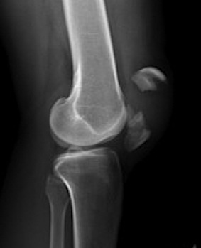 Patella Fracture | The Bone School