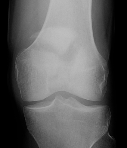 Patella Fracture | The Bone School