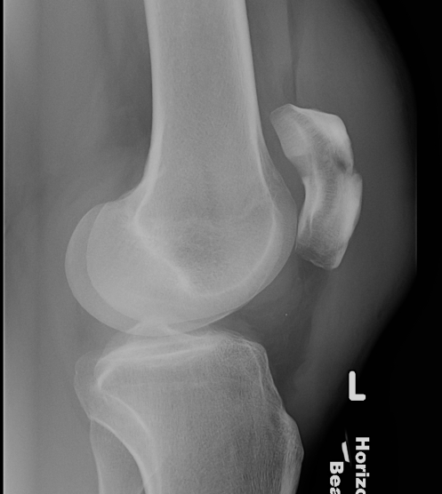 Patella Fracture | The Bone School