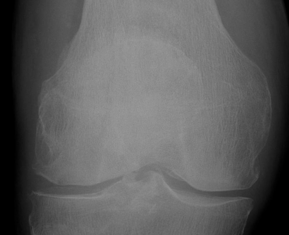 screw fixation | The Bone School