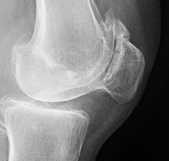 PFJ osteoarthritis | The Bone School