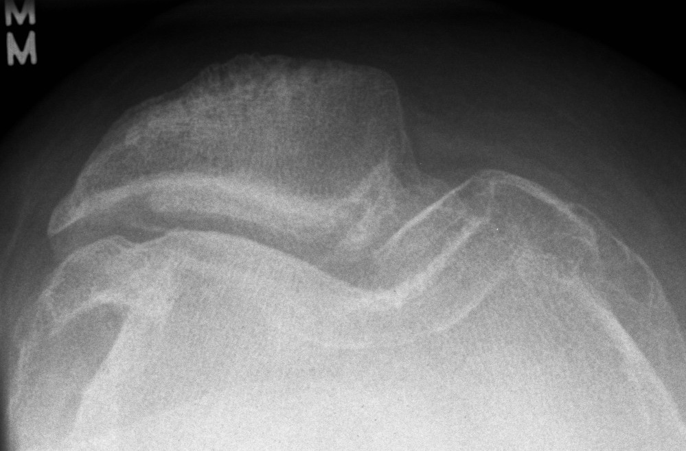 Patella Resurfacing | The Bone School