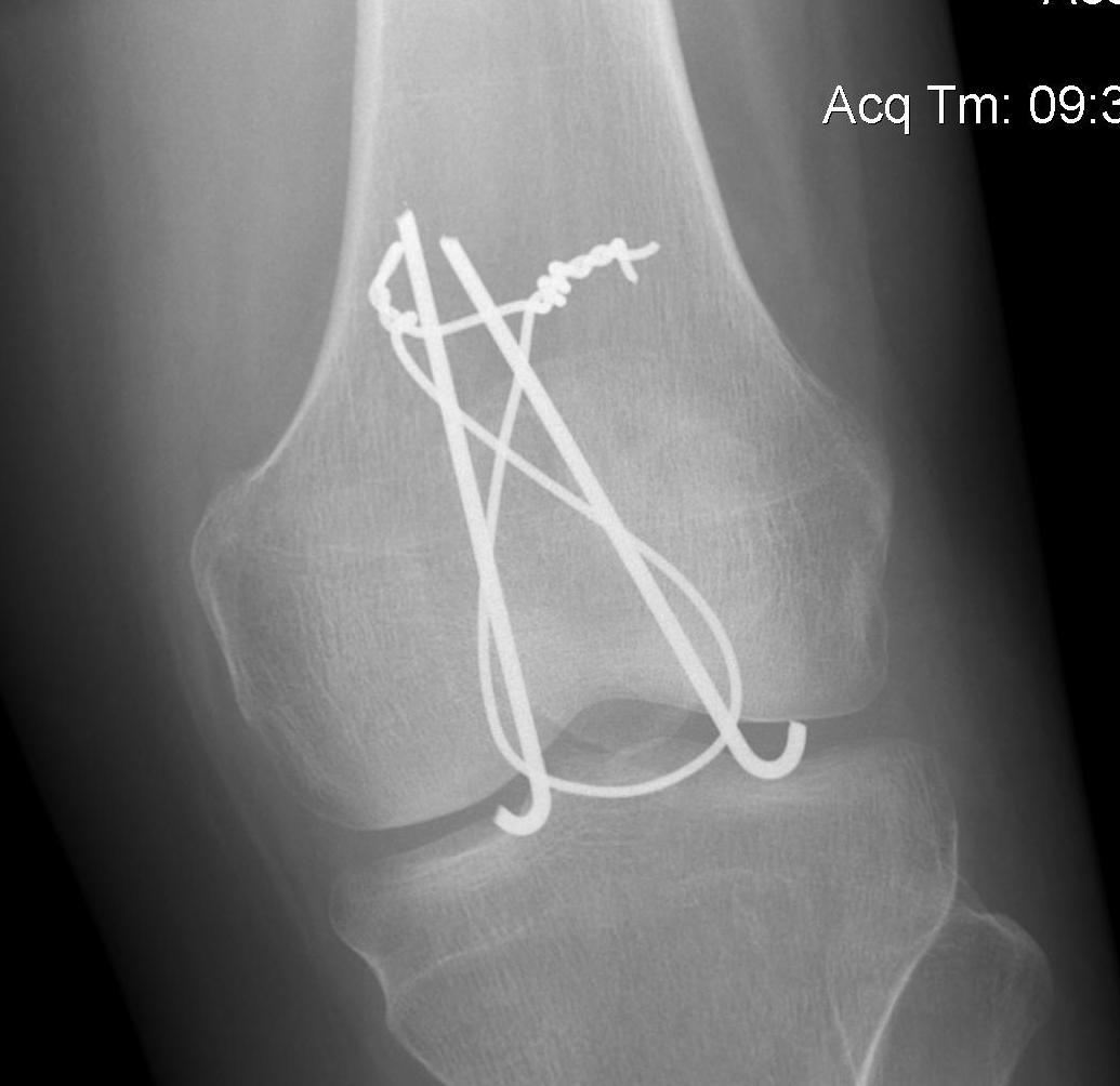 Patella Fracture | The Bone School