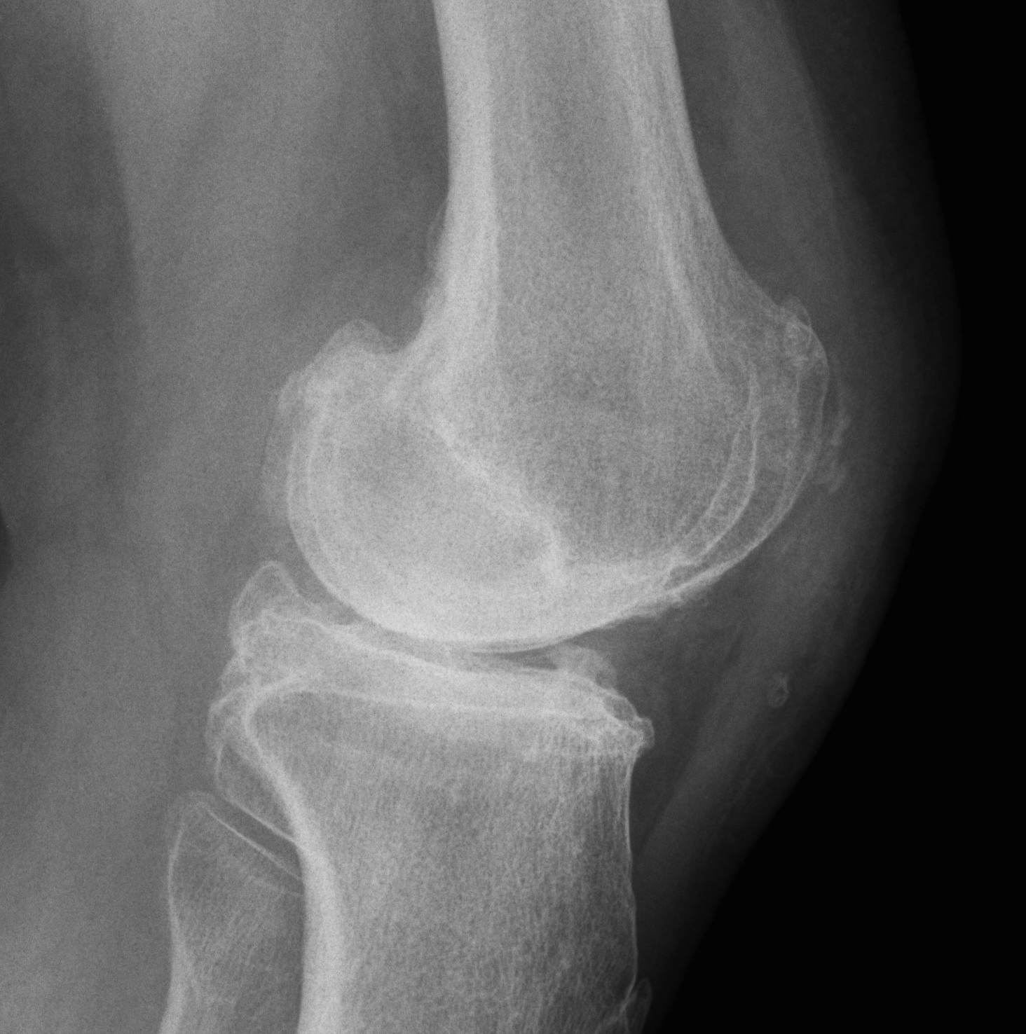 PFJ osteoarthritis | The Bone School