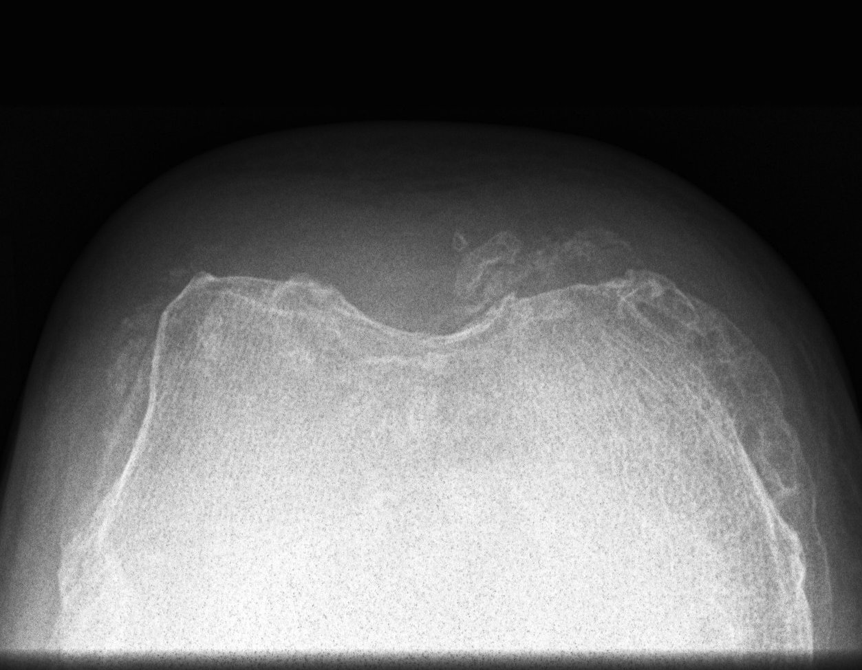 PFJ osteoarthritis | The Bone School