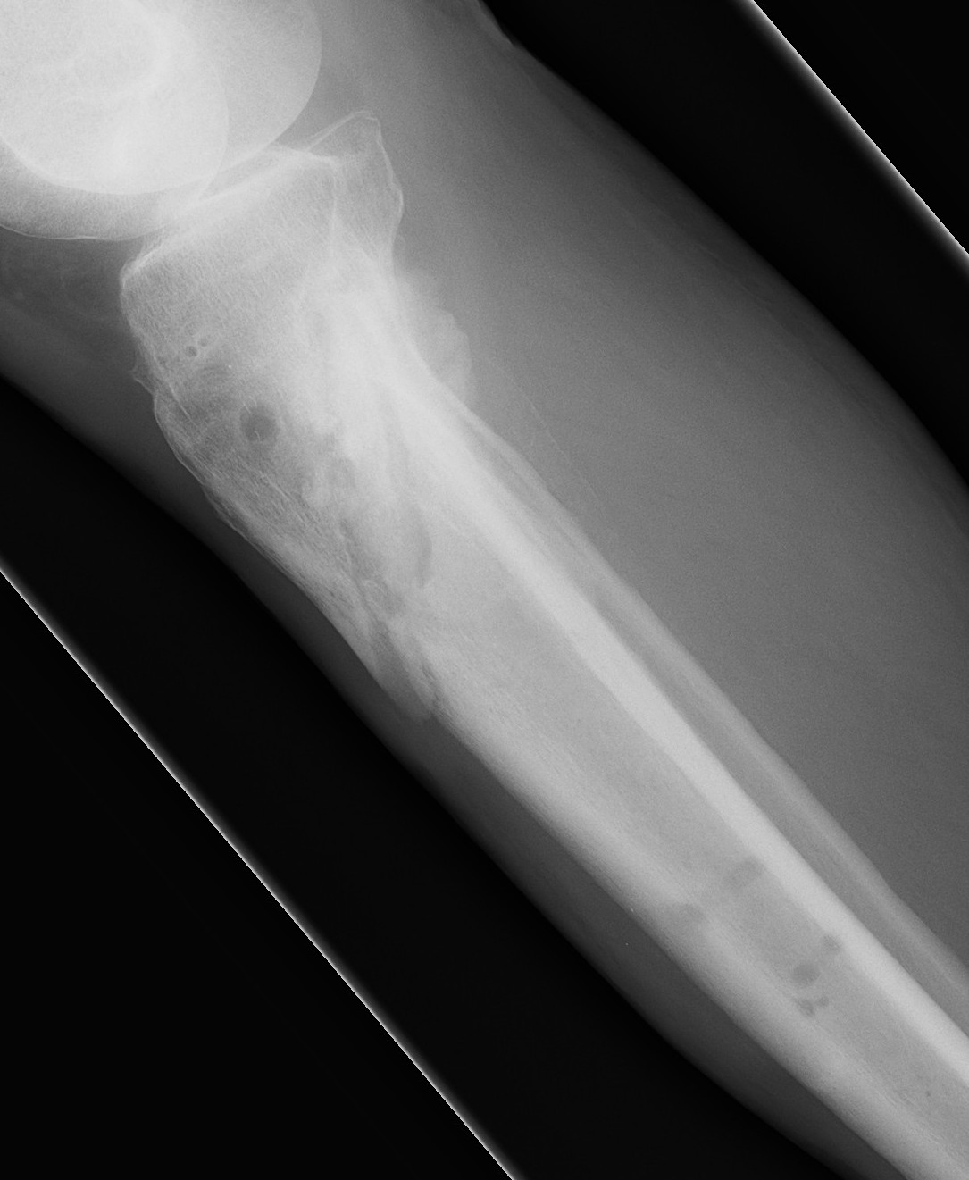 Taylor Spatial Frame | The Bone School