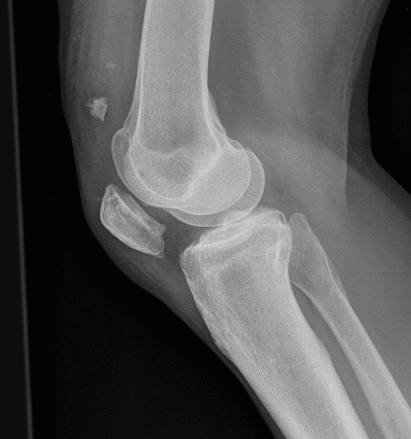 Quadriceps Tendon Rupture | The Bone School