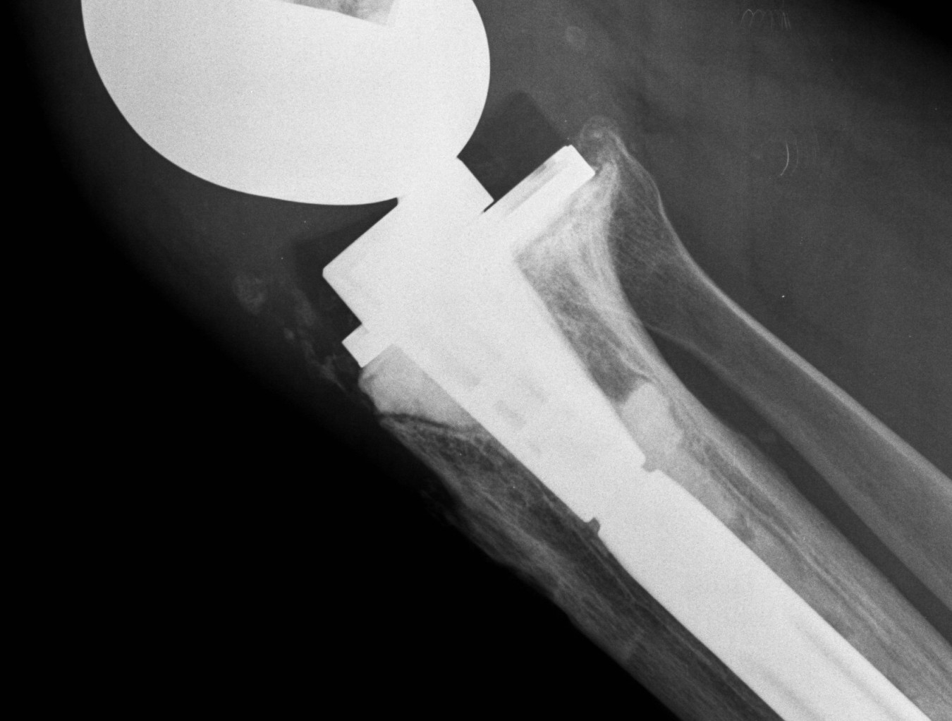Management Bone Defects | The Bone School