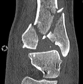 Tibial Plafond | The Bone School