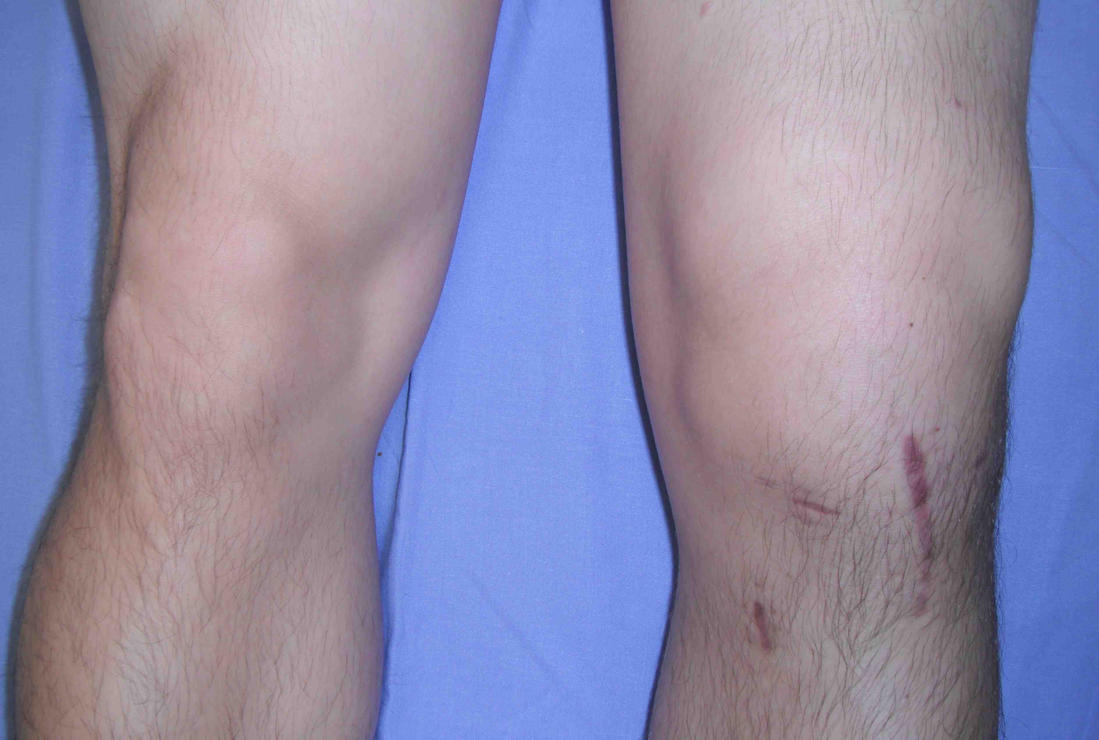 Complications | The Bone School