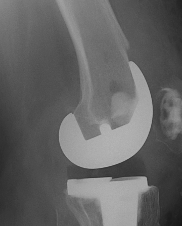 Fractures | The Bone School