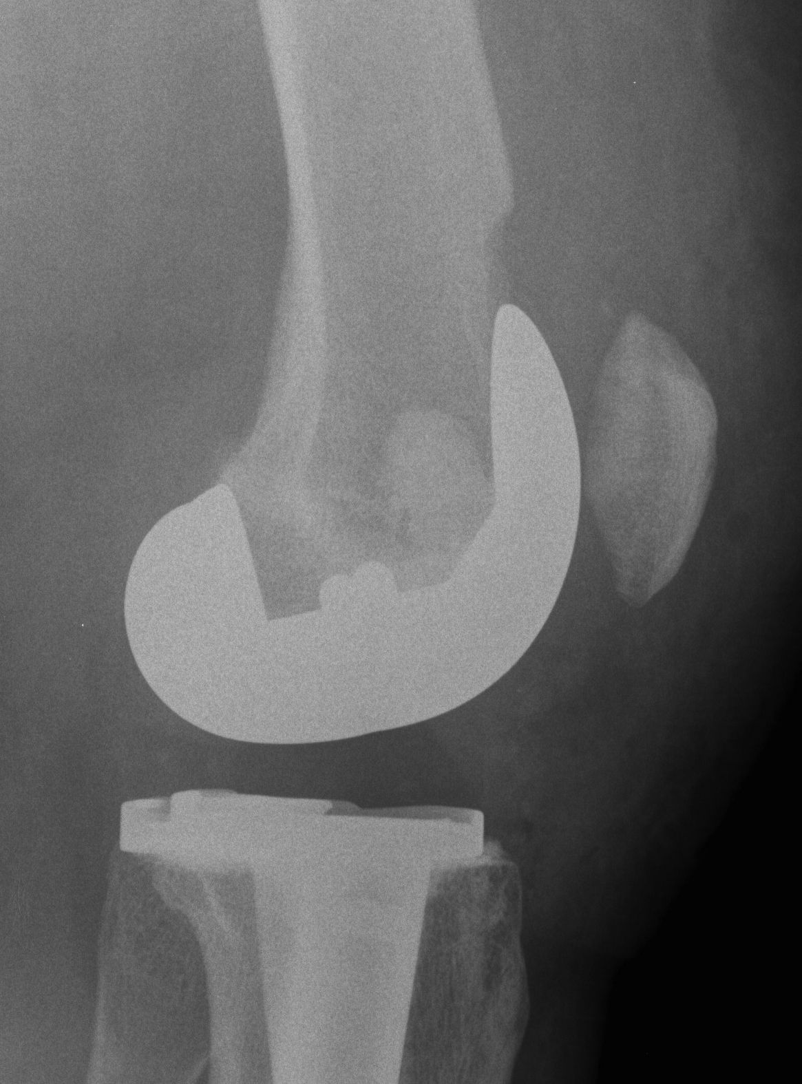 Fractures | The Bone School
