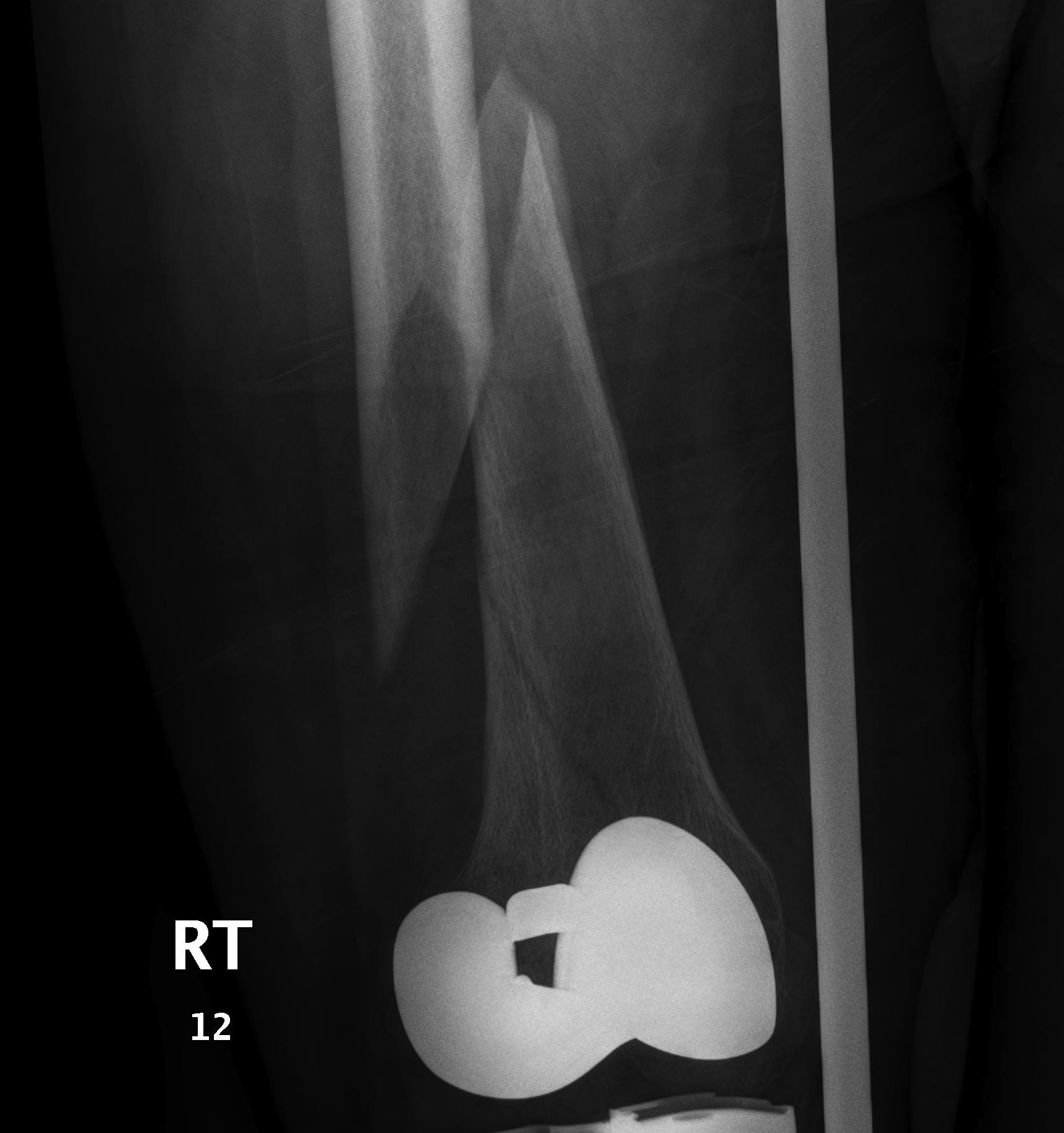Fractures | The Bone School
