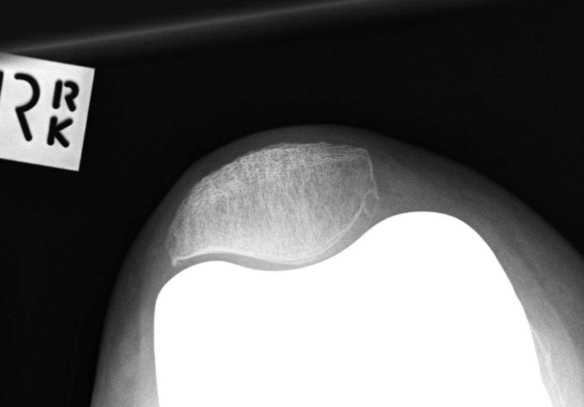 Patella | The Bone School