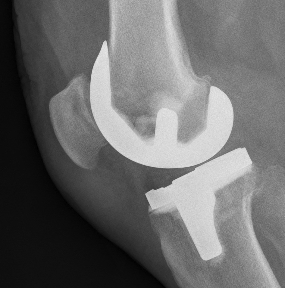Patella Resurfacing | The Bone School