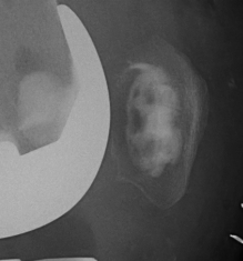 Patella Resurfacing | The Bone School
