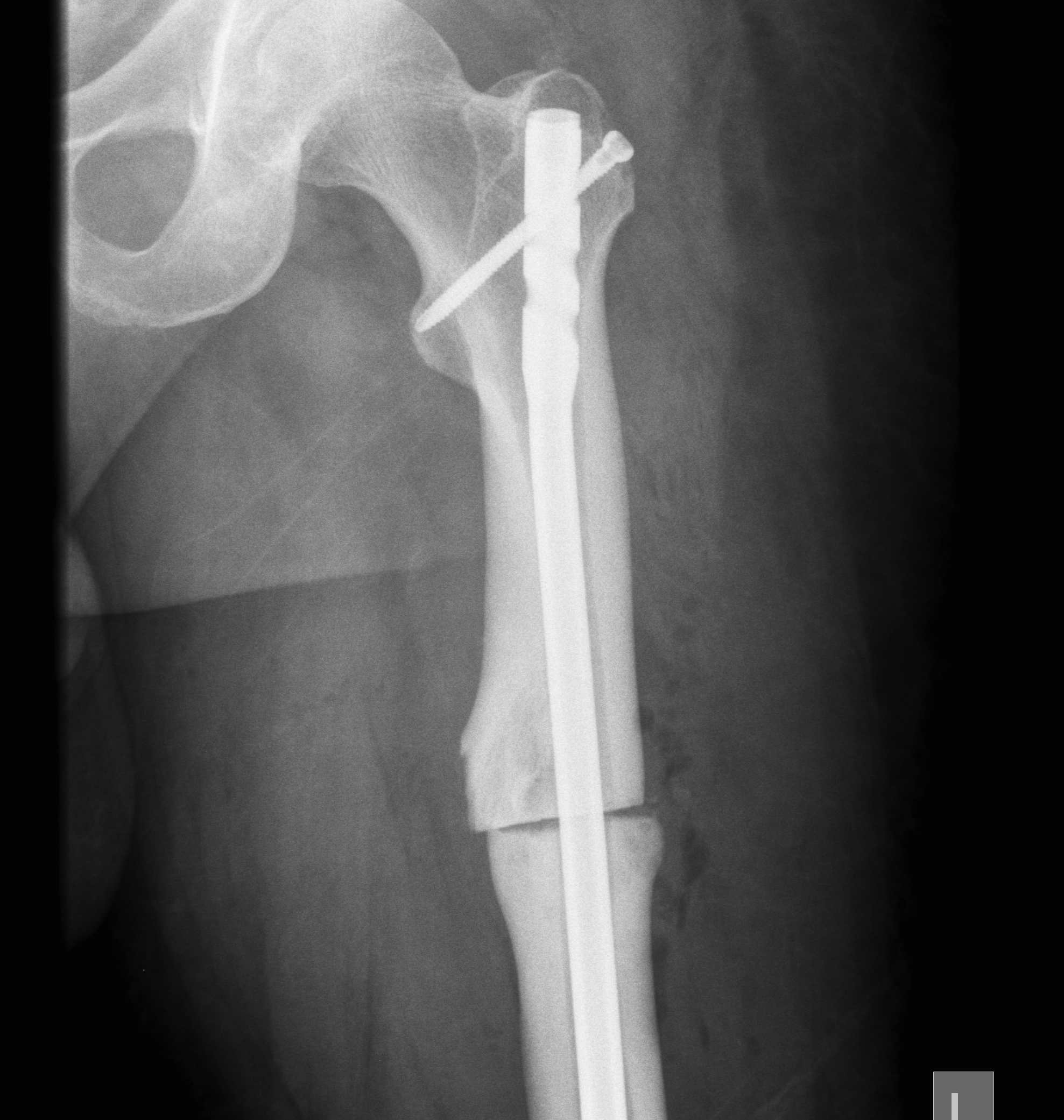 Extra-articular Deformity | The Bone School