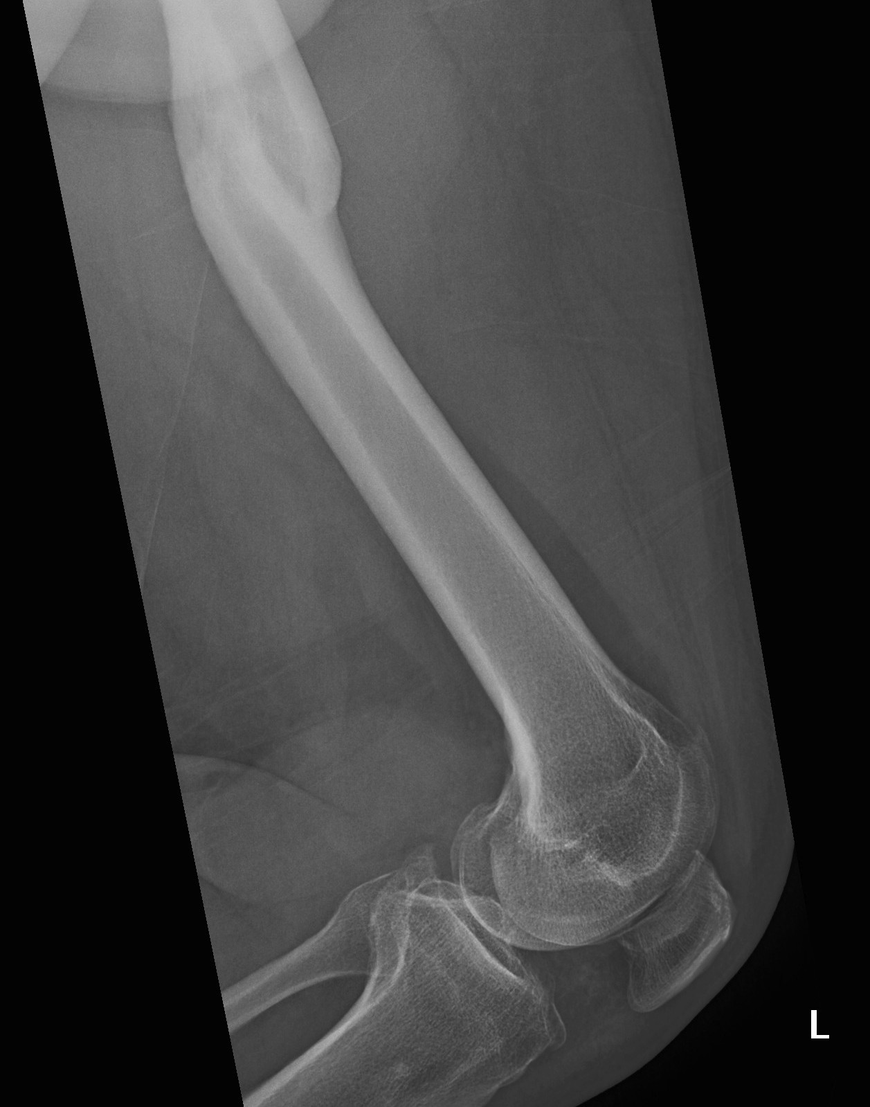 Extra-articular Deformity | The Bone School