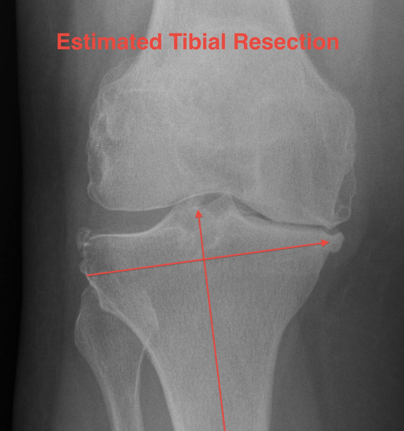 Surgical Technique Varus Knee | The Bone School