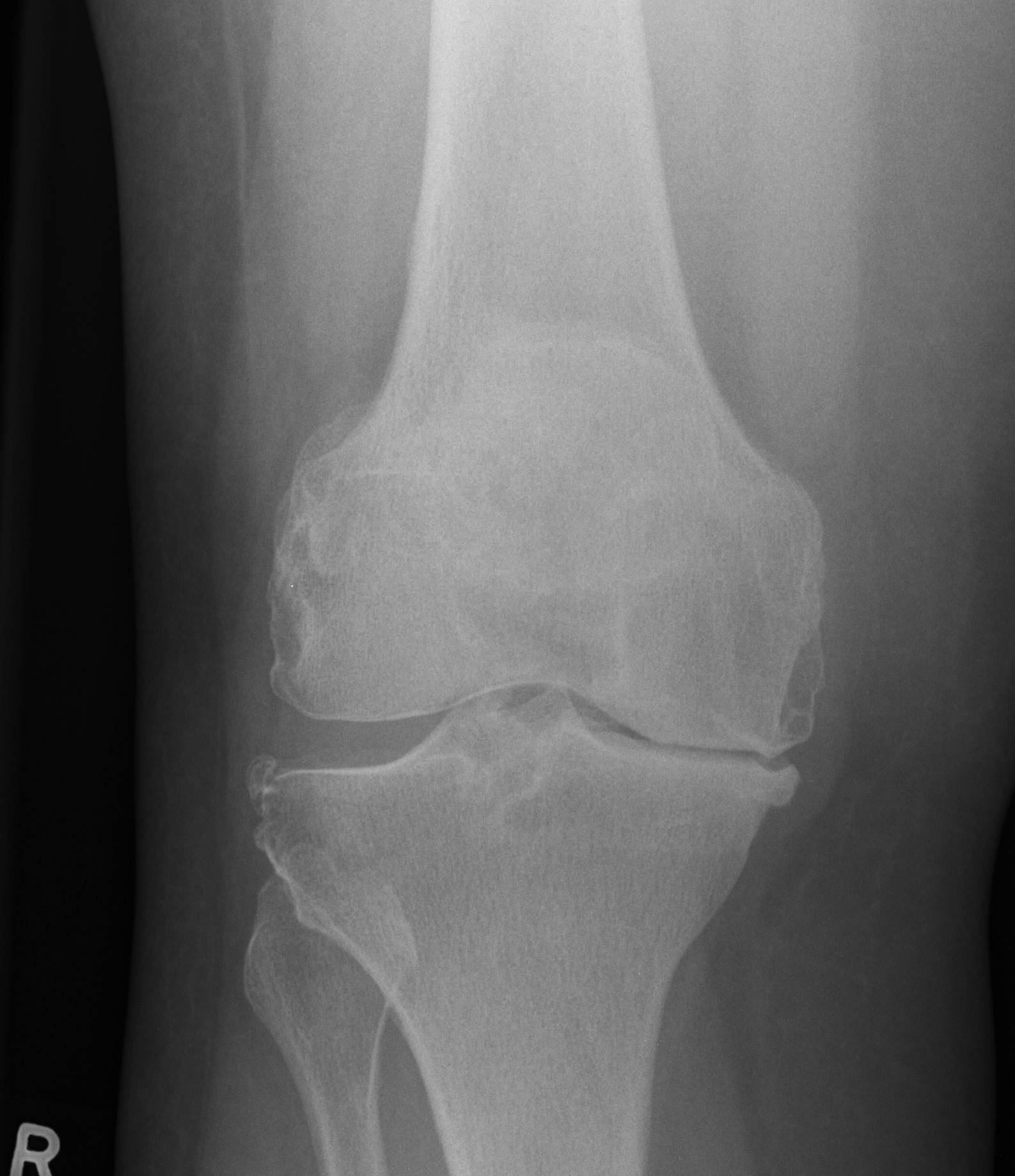 Surgical Technique Varus Knee | The Bone School