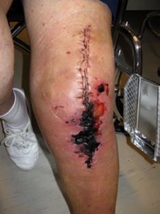 Wound Problems | The Bone School