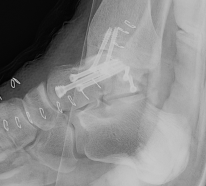 Talar body fracture | The Bone School