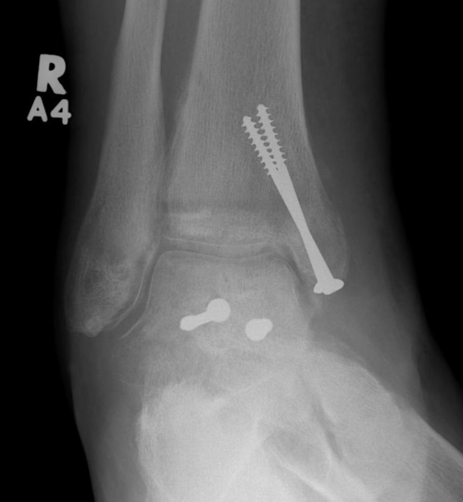 Talar body fracture | The Bone School