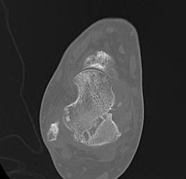 Talar body fracture | The Bone School