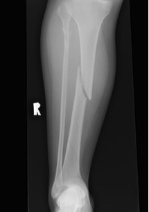 Midshaft Tibial Fracture | The Bone School