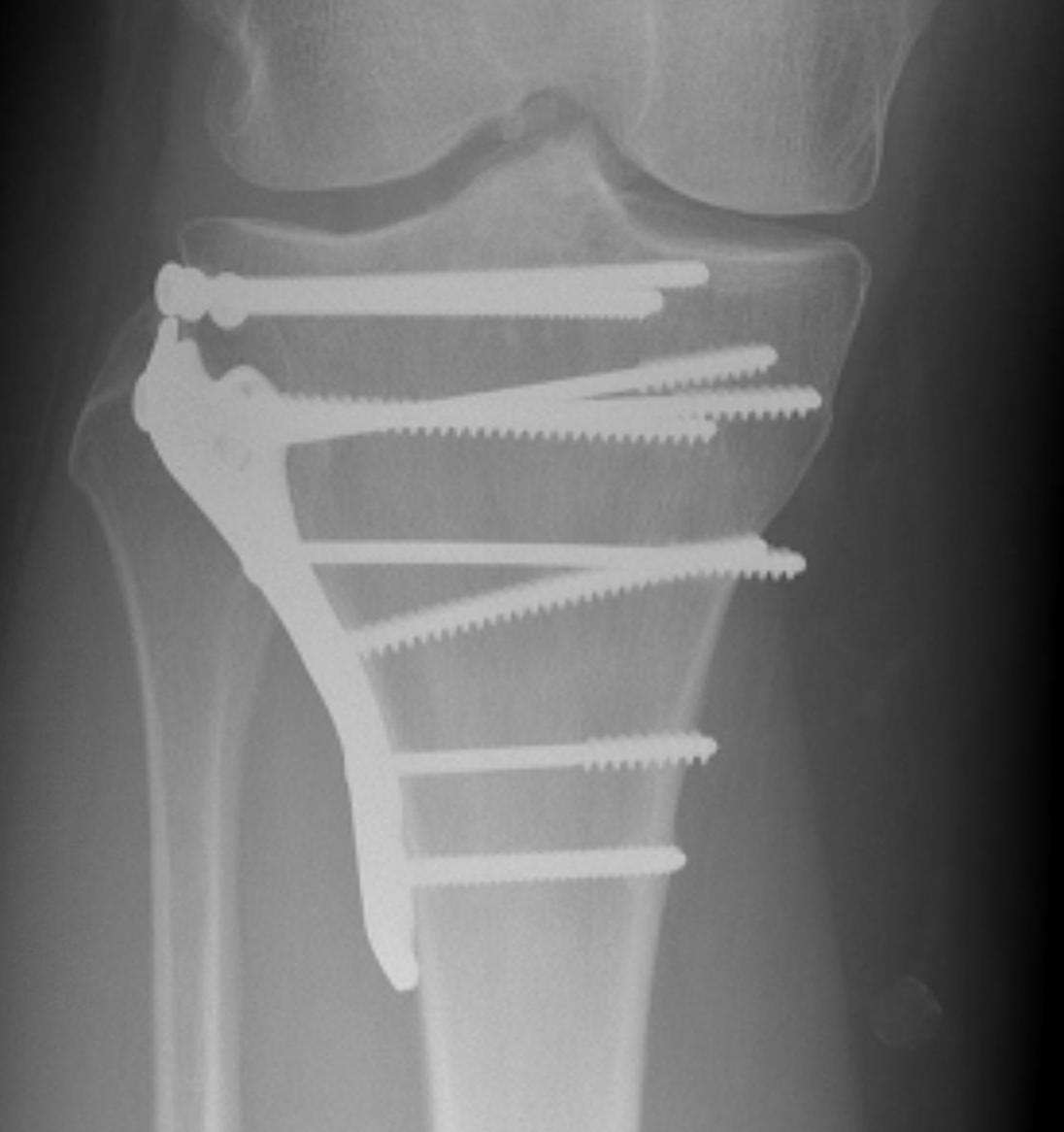 Principles of Internal Fixation | The Bone School