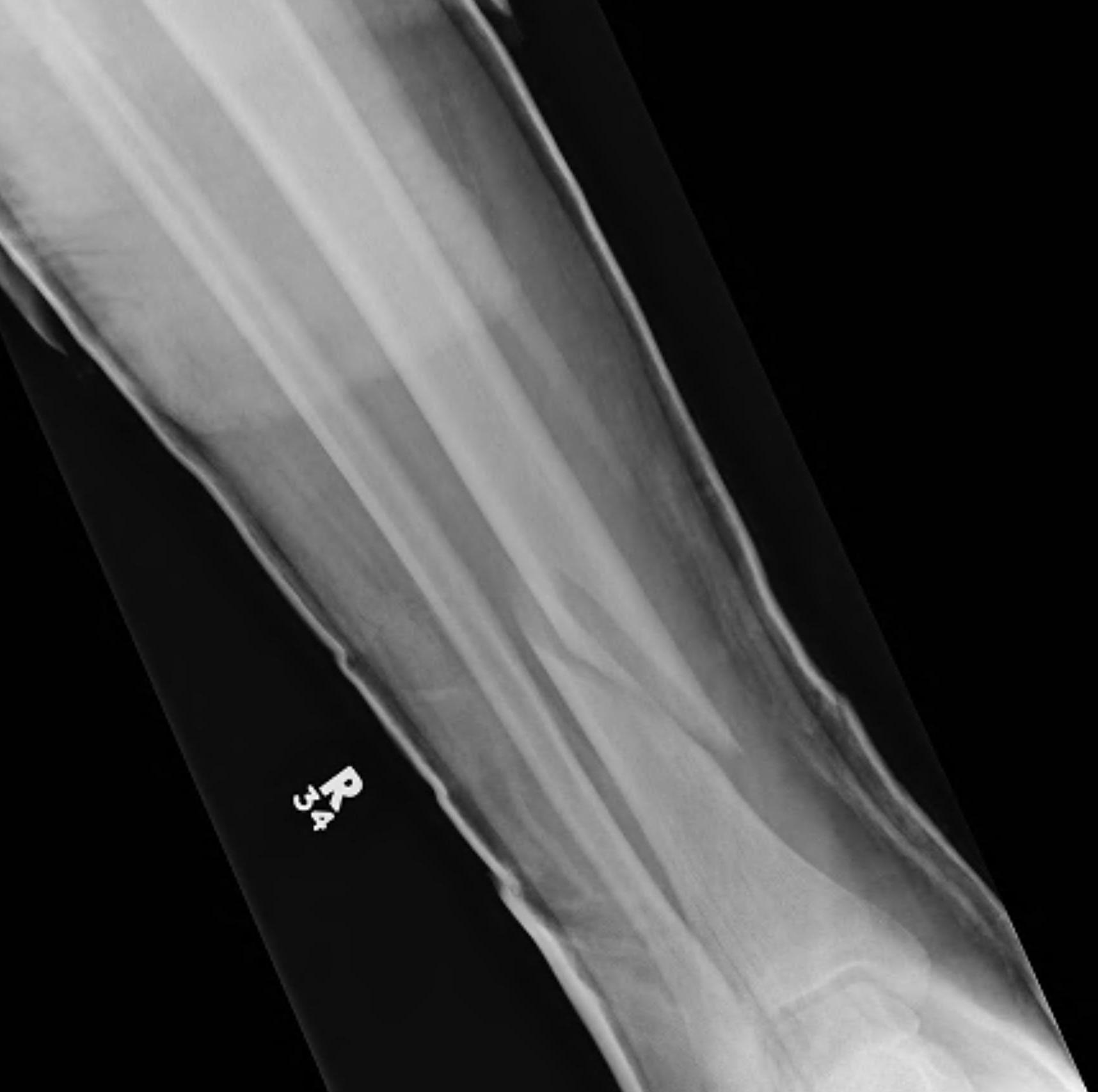 Distal Tibial Fractures | The Bone School