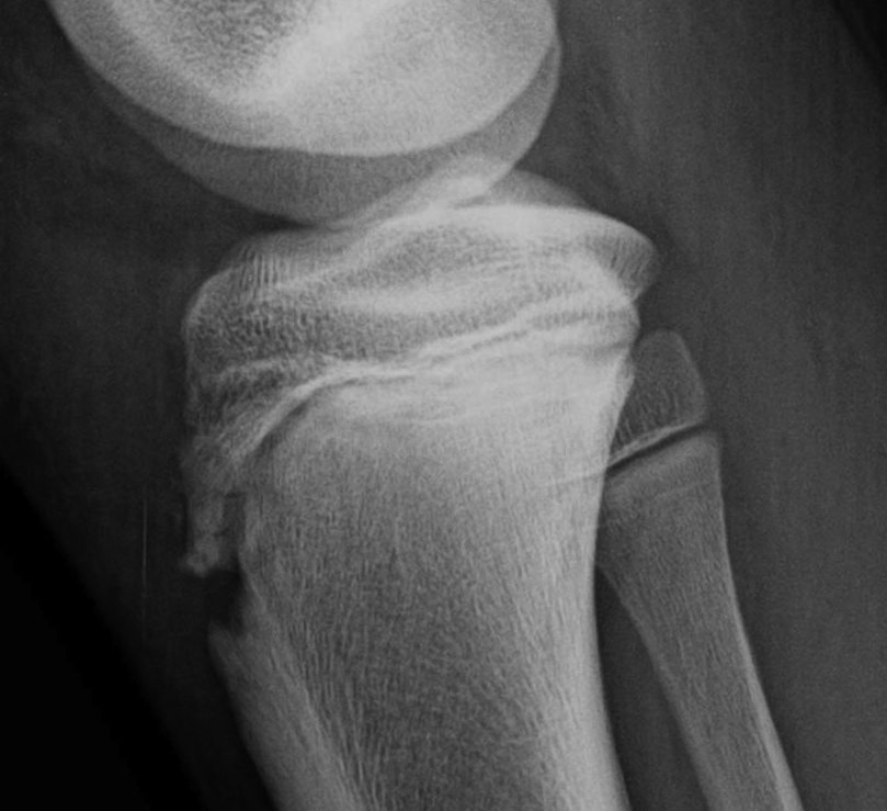 Tibial Tubercle Fractures | The Bone School