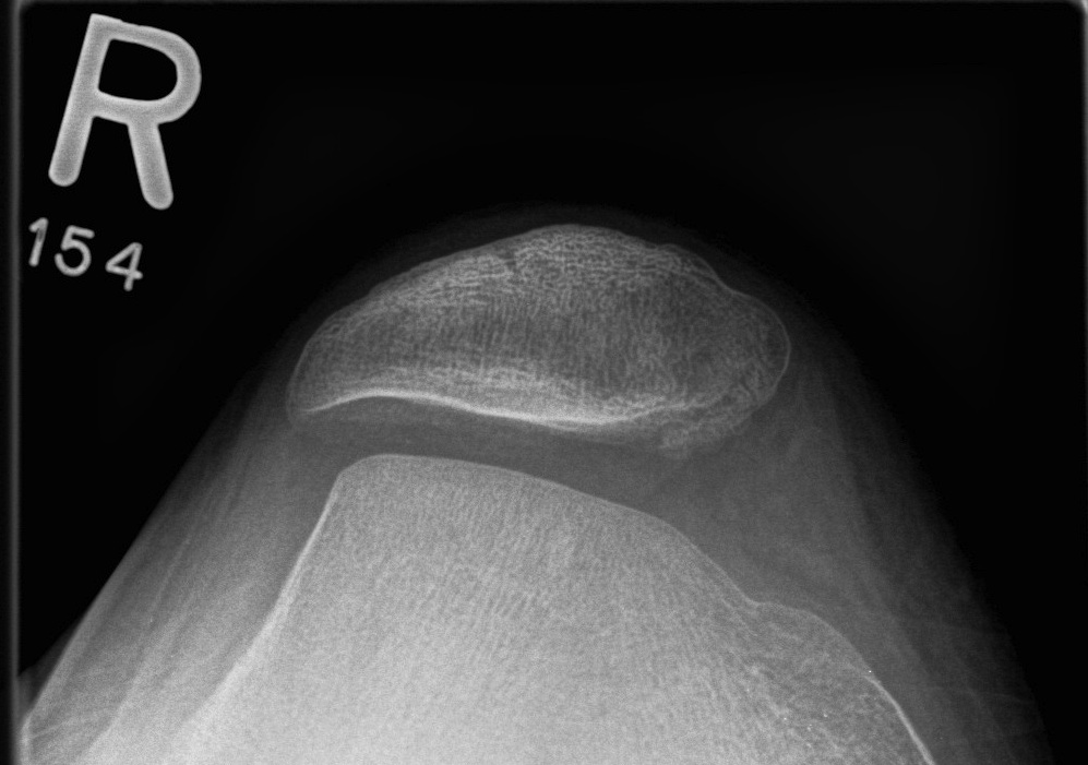 Patella Fracture Sunrise