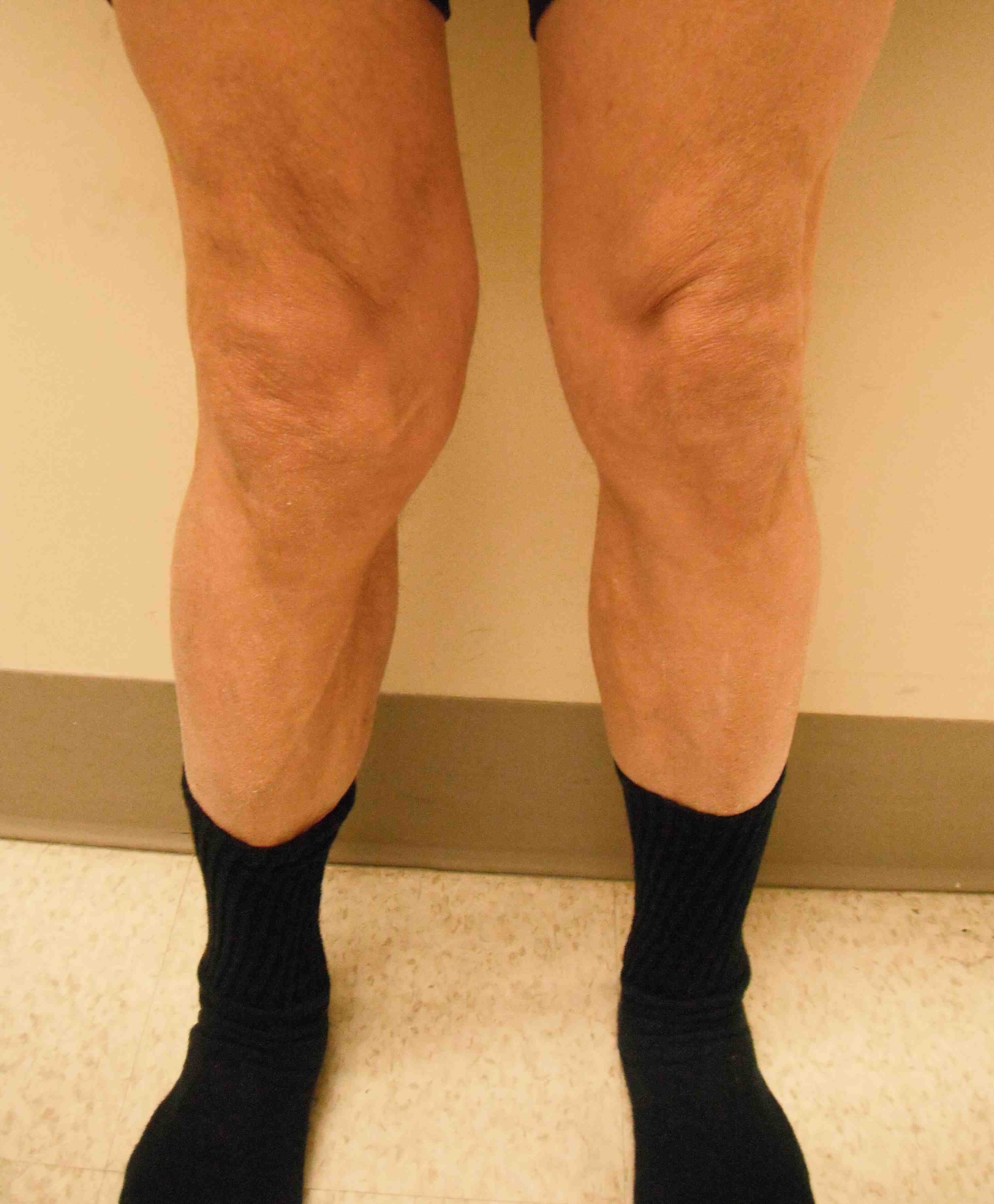 Valgus TKR | The Bone School