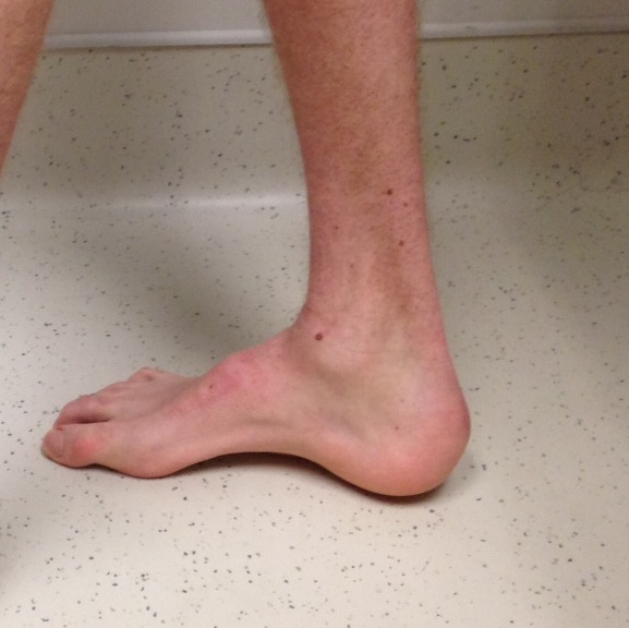 Charcot Marie Tooth | The Bone School