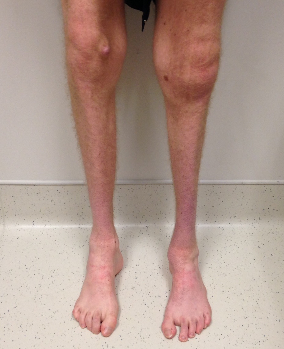 Charcot Marie Tooth | The Bone School