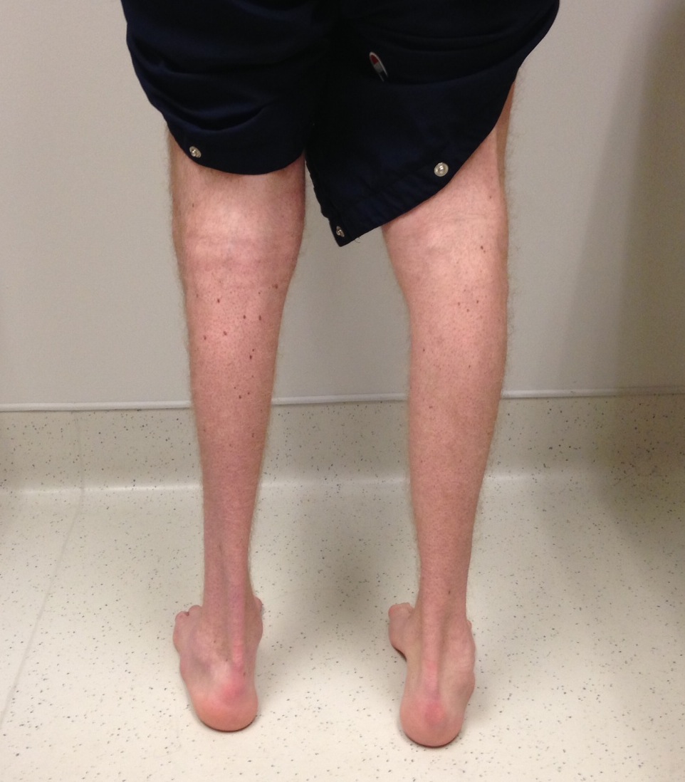 Charcot Marie Tooth | The Bone School