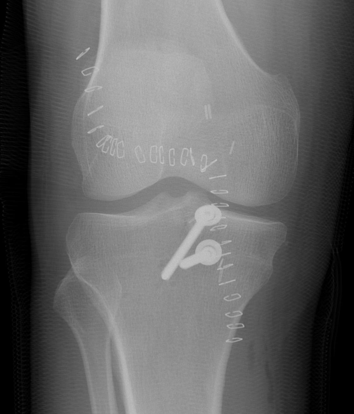 Open Approach for Bony Avulsion Surgical Technique | The Bone School