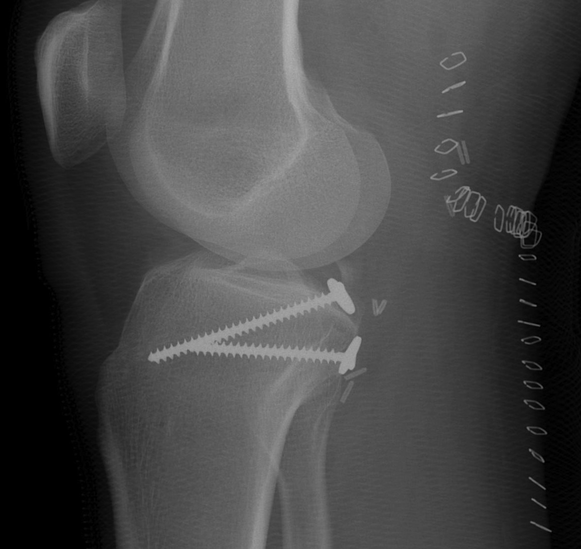 Open Approach for Bony Avulsion Surgical Technique | The Bone School